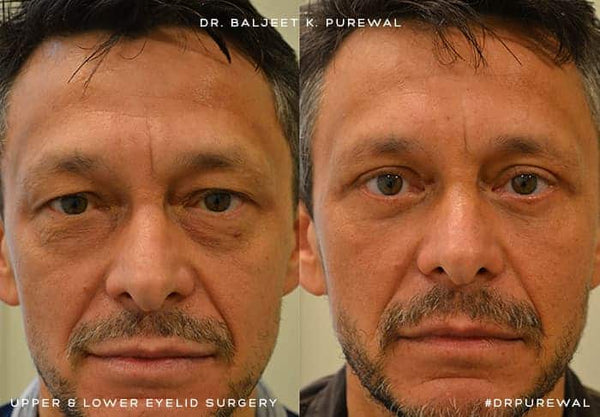 Eyelid Surgery Before & After Photos | Fresh Face + Eye, NJ