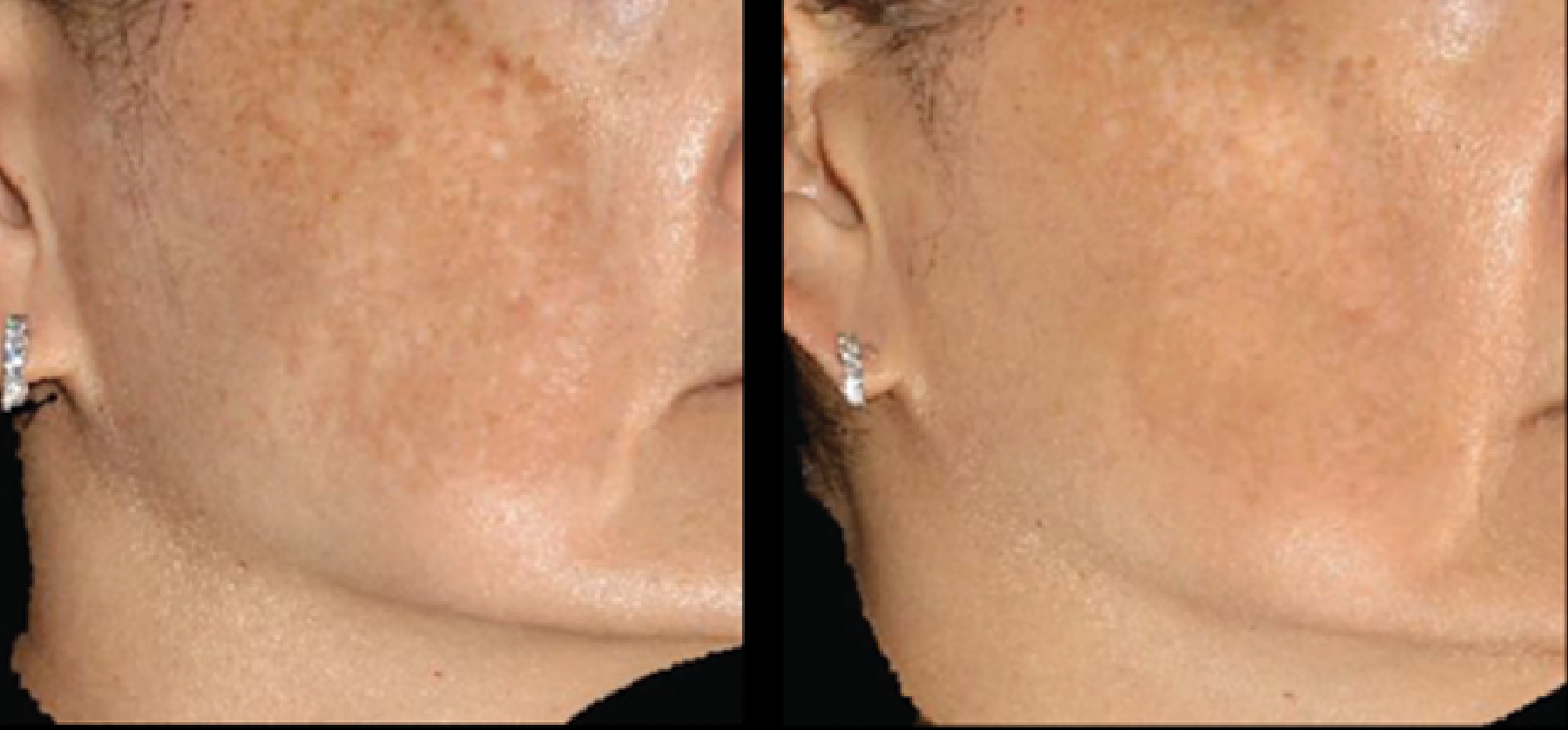 Sylfirm X Radio Frequency (RF) Microneedling - FRESH FACE + EYE Sylfirm X Radio Frequency (RF) Microneedling - FRESH FACE + EYE